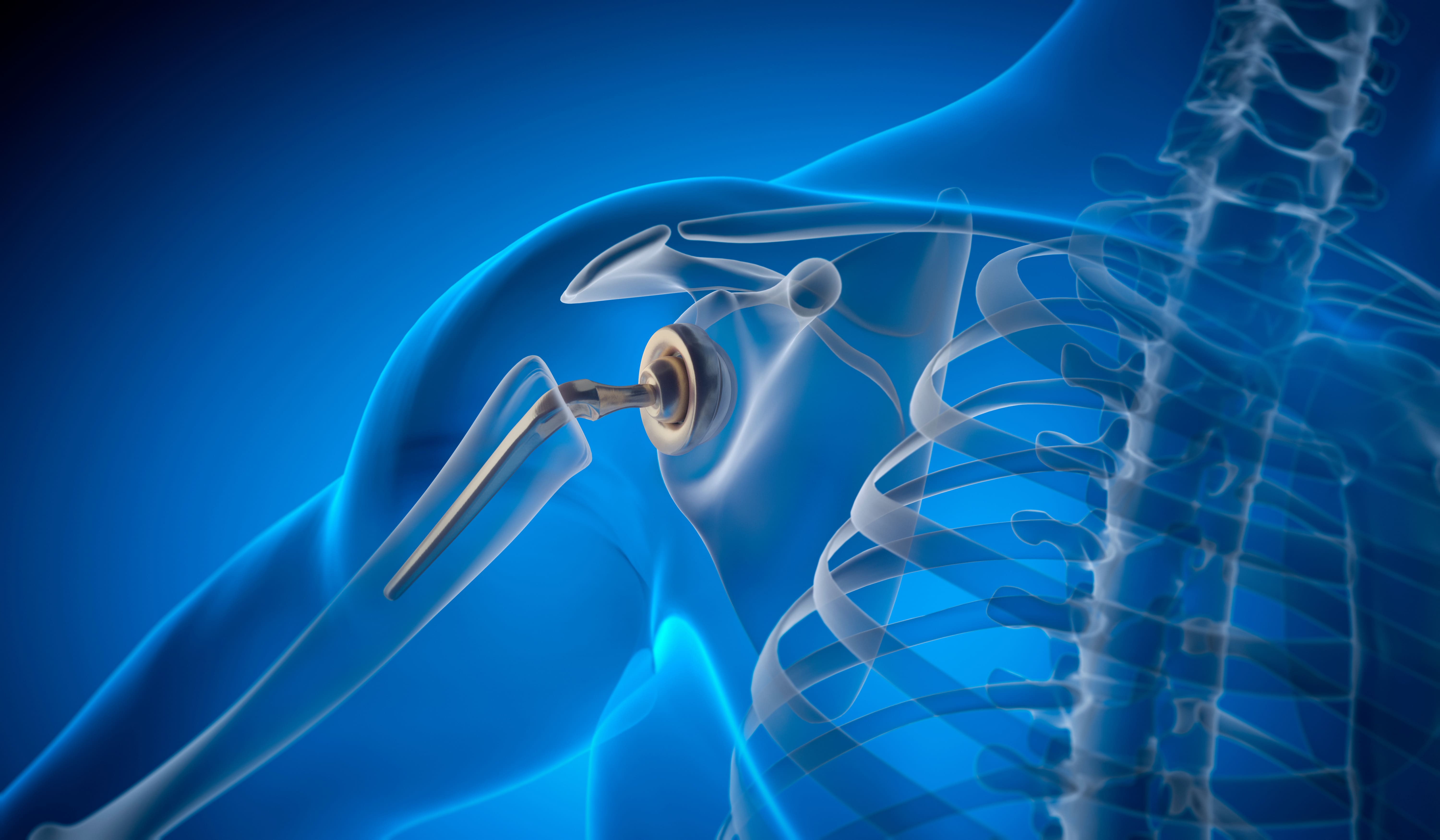 Shoulder Replacement Surgery - MedVoyage